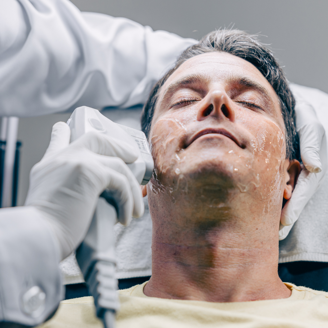 HIFU 12D - Tonifica y recude arrugas – Concepto Zero