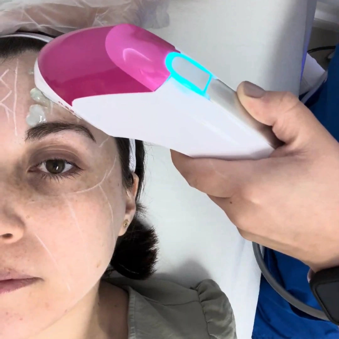 HIFU 12D Frente - Tonifica tu piel – Concepto Zero